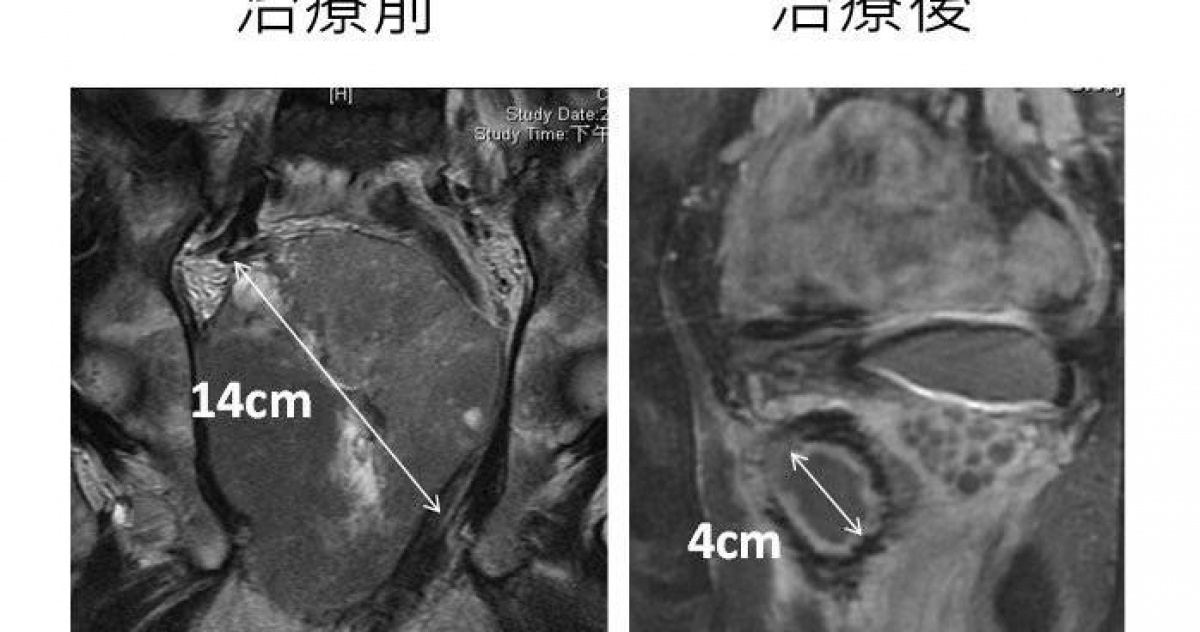 43歲男罹罕見骨盆腔肉瘤 精準醫療助攻「保住膀胱直腸」重獲新生 | 生活 | CTWANT