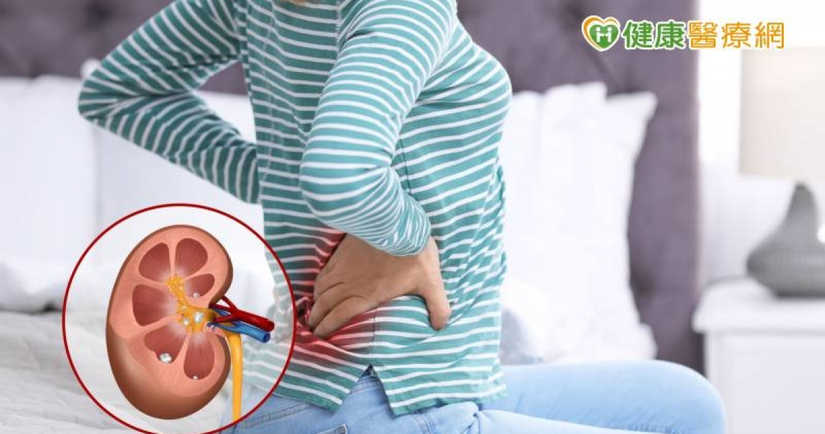 微創經皮腎臟造廔碎石手術 助老婦擺脫泌尿道感染 | 生活 | CTWANT