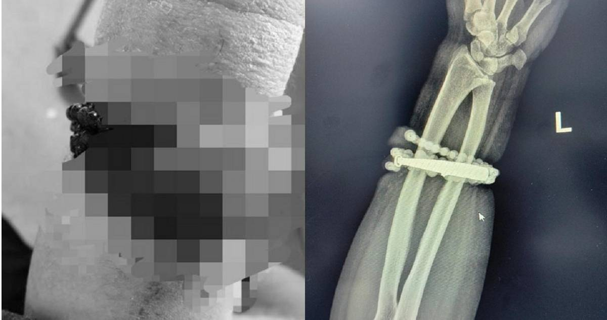 33歲女戴銀手鐲10年未摘「長進肉裡」 醫：恐引發敗血症 | 國際 | CTWANT