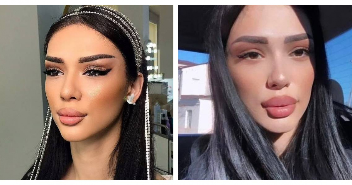 22歲正妹找好友動豐臀手術 她麻醉10分鐘後竟慘死手術台 | 國際 | CTWANT