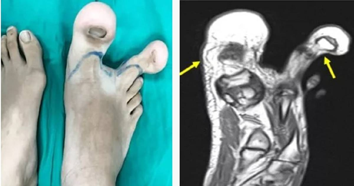 12歲女孩罹怪病長出「浩克腳趾」 她被截肢卻笑：終於能穿鞋了 | 國際 | CTWANT
