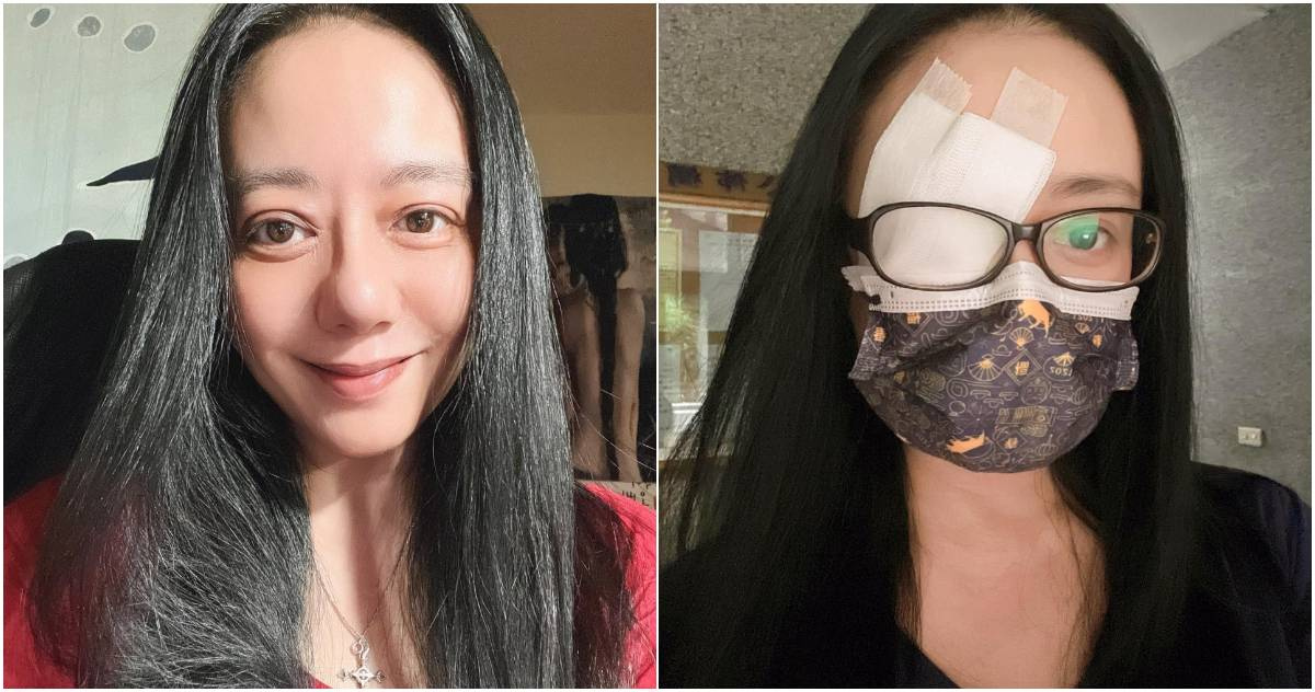 術後2個月「眼睛仍未對齊」！女星自曝：無法百分之百恢復 | 娛樂 | CTWANT