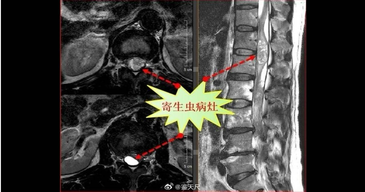 聽信民間偏方「生吞蛇膽」 導致他感染「寄生蟲」怪病纏身多年 | 生活 | CTWANT