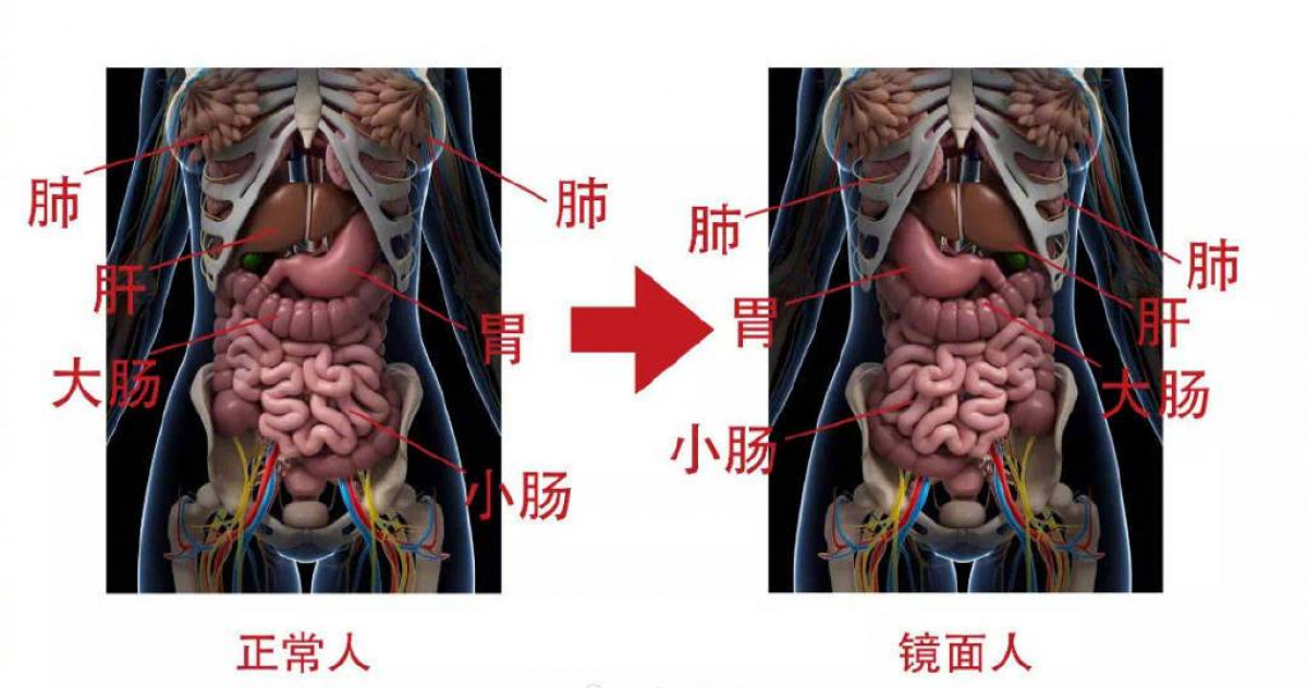 女就醫驚見「五臟六腑反著長」 醫曝真實原因：恐帶來巨大障礙 | 國際 | CTWANT
