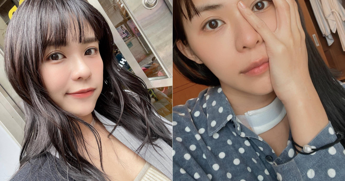 本土劇女星甲狀腺長3.5cm腫瘤 開刀後照鏡子崩潰「怎麼變醜了」 | 娛樂 | CTWANT