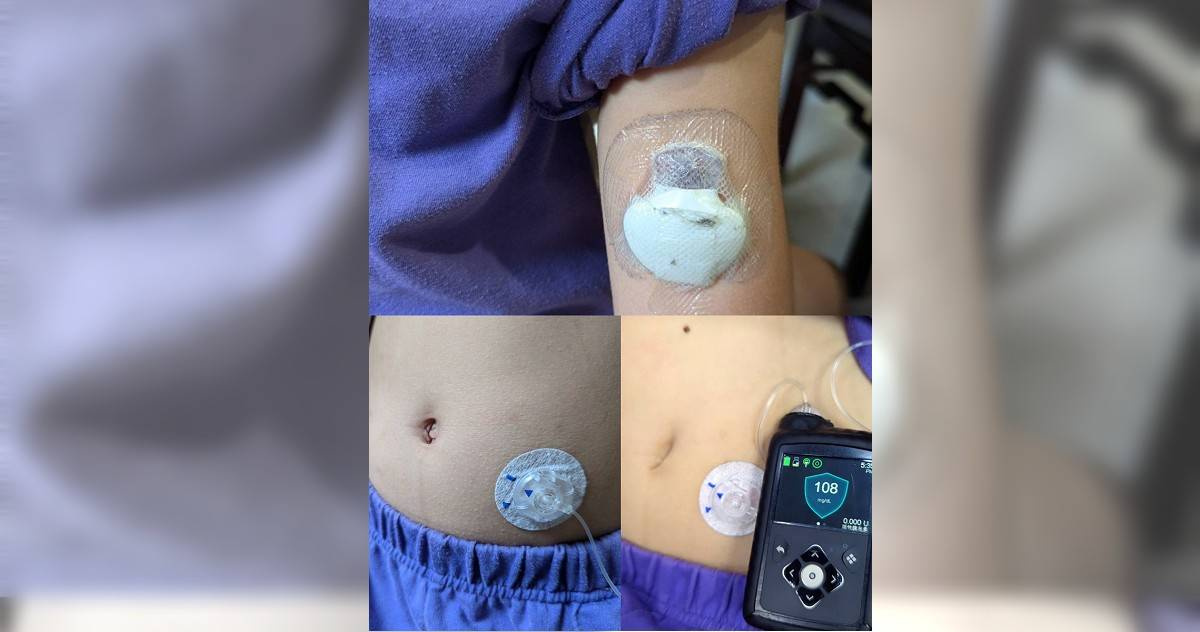 雙管齊下「即時監控血糖、精準給予胰島素」 糖尿病童免扎針之苦 | 生活 | CTWANT