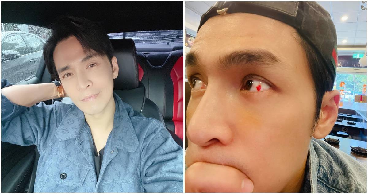 Gino「誤傷左眼」微血管破裂…傷勢照曝光 粉絲心疼：保重 | 娛樂 | CTWANT