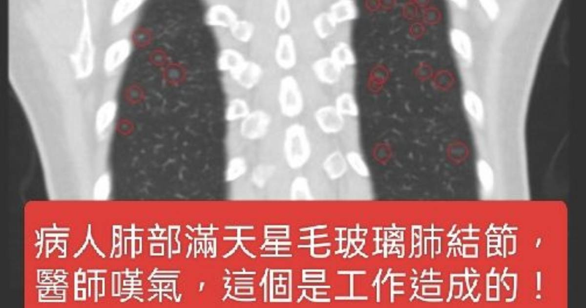 60歲婦人上班就咳嗽！肺部驚見「滿天星」結節 醫一聽工作：趕快轉行 | 生活 | CTWANT