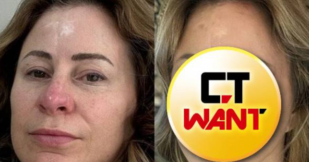 不滿臉部老化下垂 50歲美女「賣房子籌錢整形」成效太驚人 | 國際 | CTWANT