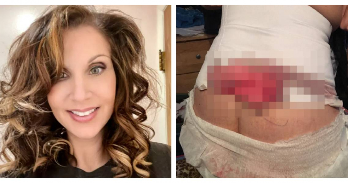 地方媽媽隆乳救婚姻竟留下「臭傷口」 她怨胸部形狀不一：宛如情色女星 | 國際 | CTWANT