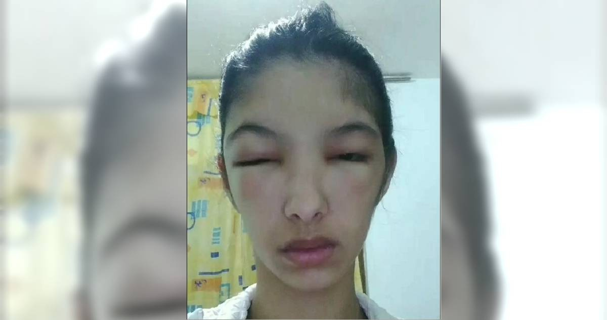 女網紅DIY染髮引起過敏 全臉腫脹不堪、頭皮流膿慘毀容 | 國際 | CTWANT