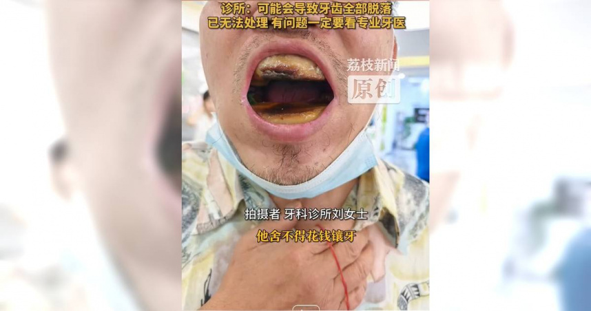 嫌牙醫太貴！陸男異想天開買樹脂「補牙DIY」 張嘴糊成「烤年糕」牙醫都沒轍 | 國際 | CTWANT