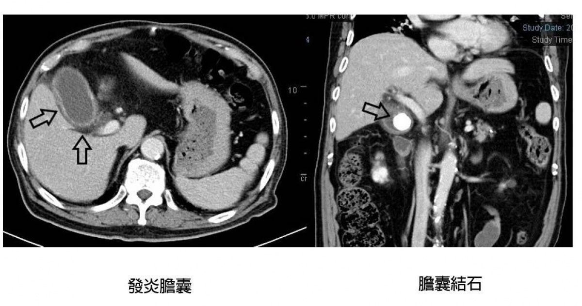 85歲老翁急性膽囊炎 內視鏡超音波「取石」不須開刀 | 生活 | CTWANT