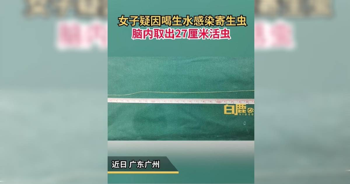 20歲女頭疼吃藥2年不好 竟是27公分「裂頭蚴」寄居腦內 | 國際 | CTWANT