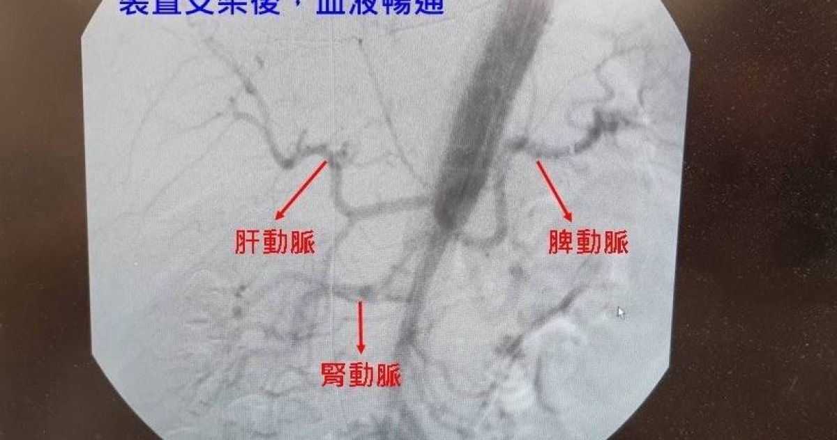 43歲男先腹痛再背痛 險喪命！一檢查竟是主動脈剝離 | 生活 | CTWANT