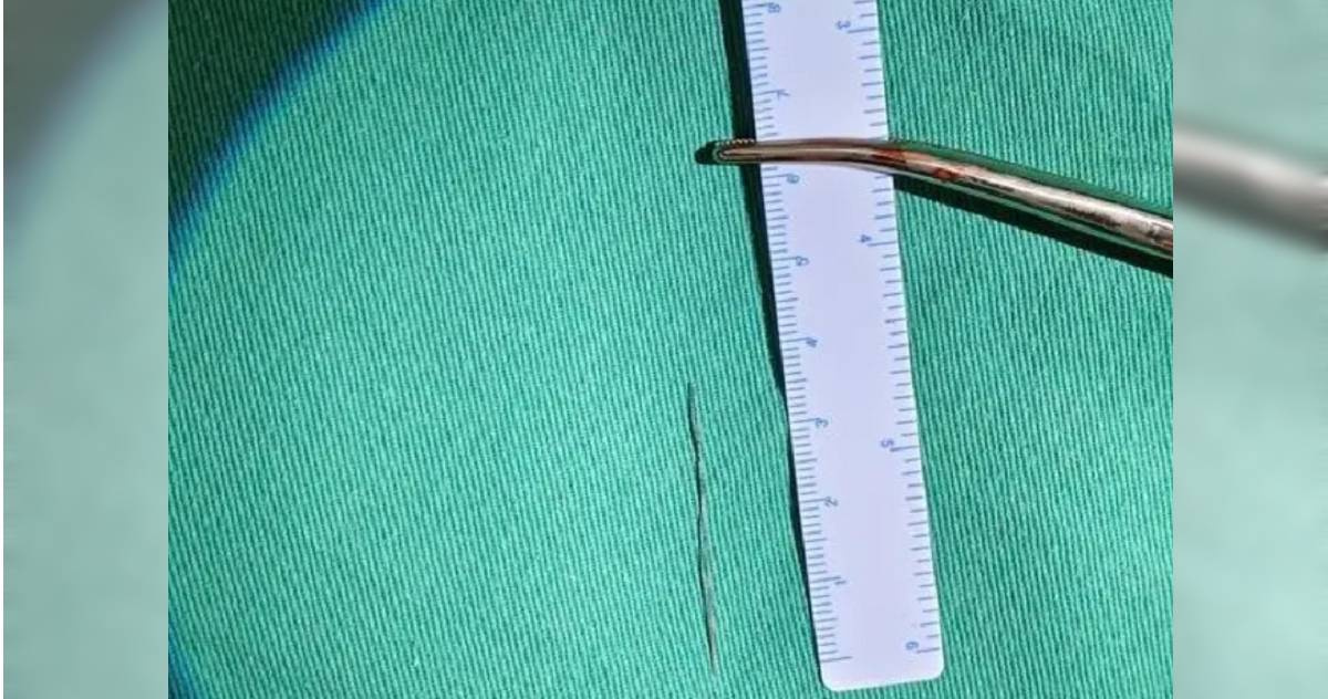 36歲男頭痛在家DIY針灸！紮破心臟遺留3公分針頭 3個月後才就醫下場曝 | 生活 | CTWANT