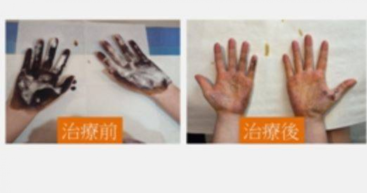 吹冷氣也狂噴汗！15歲妹「身飄異味」羞愧躲同學 手抹1物秒冒紫斑 | 生活 | CTWANT